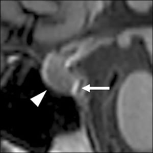 Acute Sheehan Syndrome With Distinctive Arginine Vasopressin Secretion ...