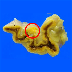 Adrenocortical Tumor Associated With Pathogenic Variant in KCNJ5 and ...