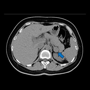 Atypical Imaging Findings in a Cortisol-Producing Adrenal Adenoma ...