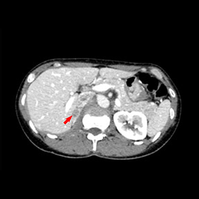 Bilateral Adrenalectomy for Bilateral Adenomas | Endocrine Society