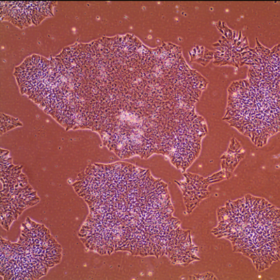 β Cells From iPSC of a Patient with MODY8 | Endocrine Society