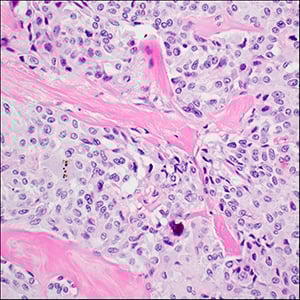 Detection of SEZ6, a Therapeutic Target, in Medullary Thyroid Carcinoma ...