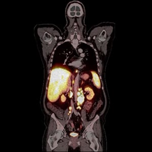 Efficacy of Racecadotril in a Patient Affected by a Therapy-Refractory ...