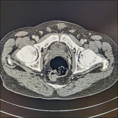 Emerging Role of Gallium-68 DOTANOC PET/CT Guided Radiofrequency ...
