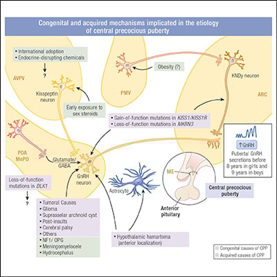Etiology of Central Precocious Puberty | Endocrine Society
