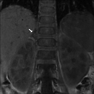 Familial Glucocorticoid Deficiency in Twins | Endocrine Society
