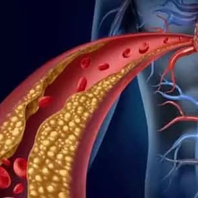 Management of Familial Hypercholesterolemia | Endocrine Society