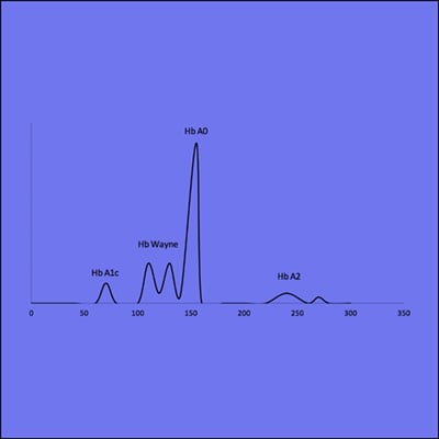 Hemoglobin Wayne Variant | Endocrine Society