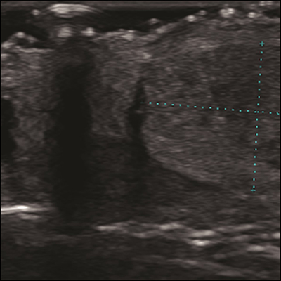 Hypogonadism Workup XX Genotype | Endocrine Society