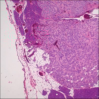 Insulinoma and Postprandial Hypoglycemia in MEN-1 | Endocrine Society