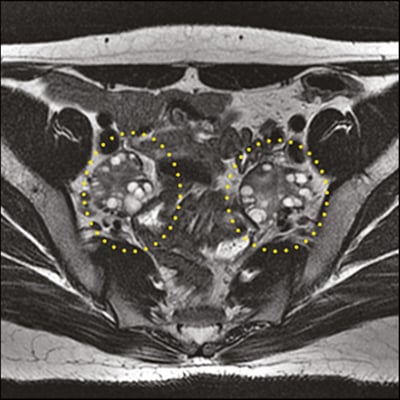 Monogenic Etiologies in Polycystic Ovary Syndrome | Endocrine Society