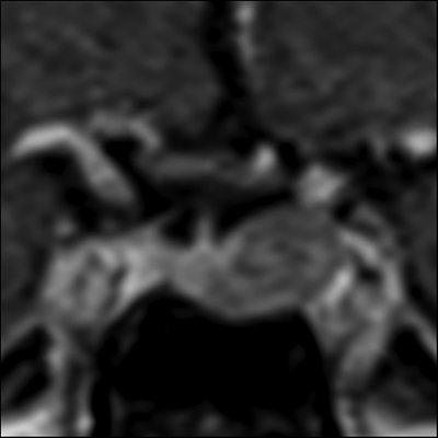 Pancreatic ACTH Hypersecretion and Pituitary Macroadenoma | Endocrine ...