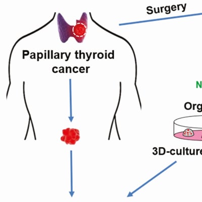 Papillary Thyroid Cancer Organoids | Endocrine Society