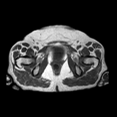 Pelvis Magnetic Resonance Imaging to Diagnose Familial Partial ...