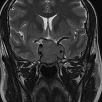 Plurihormonal Pituitary Adenoma | Endocrine Society
