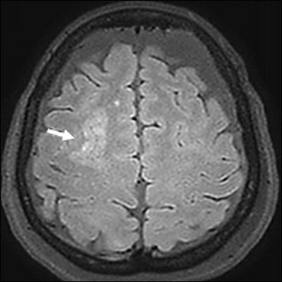 PRES From Calcium Over-Replacement | Endocrine Society