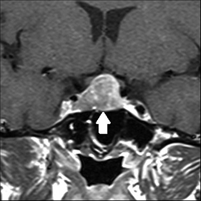 Prolonged Adrenal Insufficiency After Osilodrostat Exposure With ...