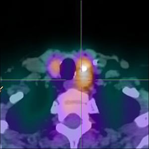 Refractory Hypercalcemia Secondary to Metastatic Parathyroid Carcinoma ...
