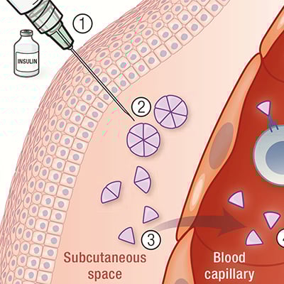 The Evolution of Insulin and Insulin Therapy | Endocrine Society