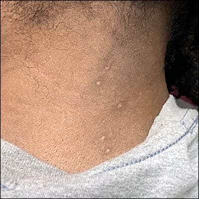 Type B Insulin Resistance Syndrome | Endocrine Society