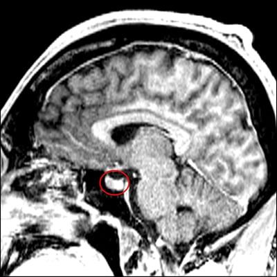 Uncontrolled Acromegaly Resulting in the Need for Left Ventricular ...