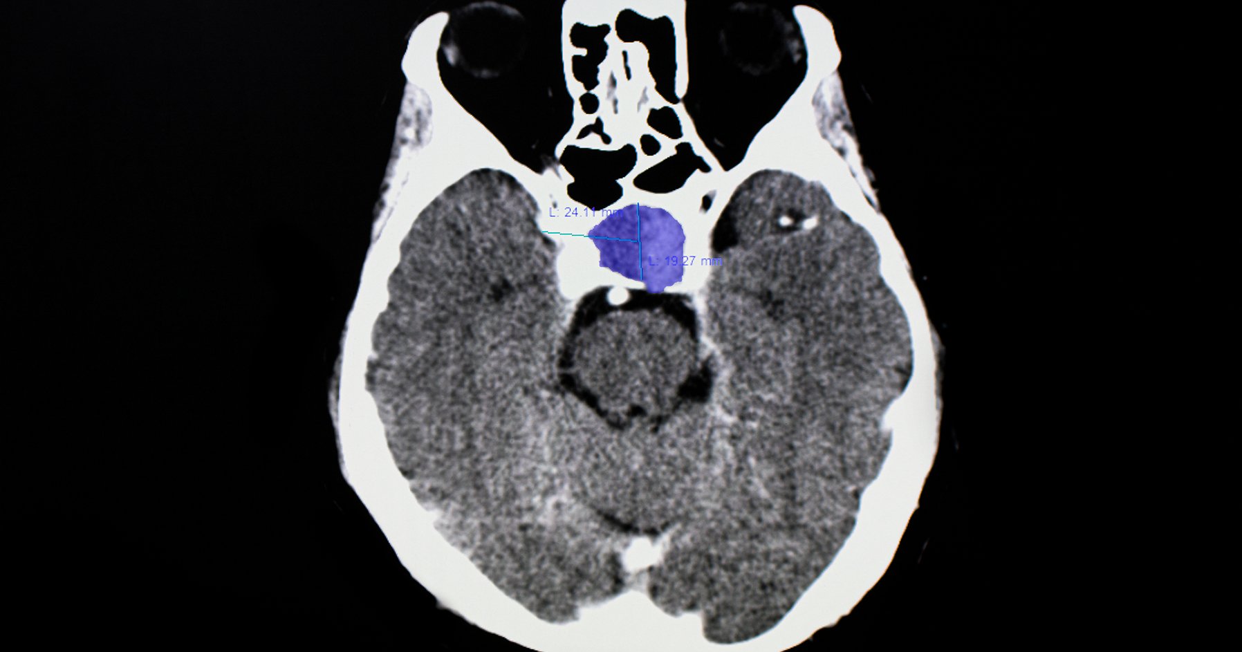 Pituitary Tumors Endocrine Society